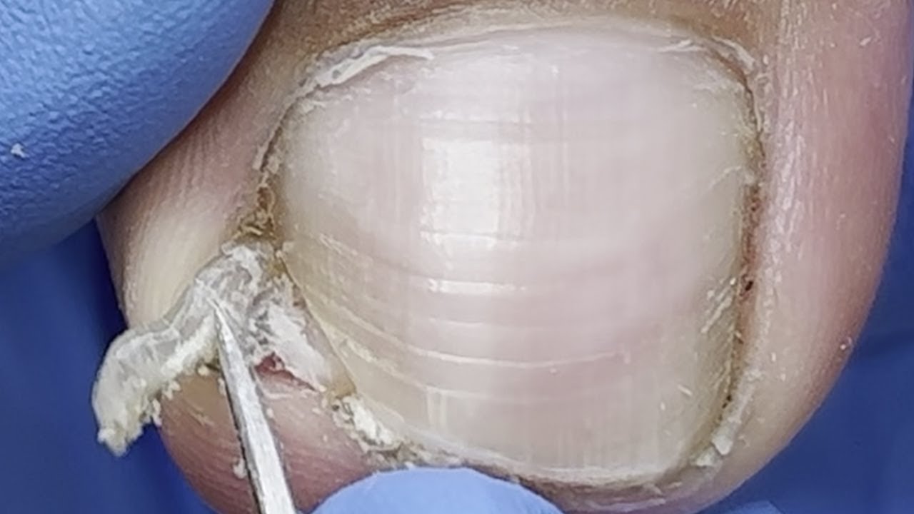 Professional pedicure: hidden ingrown nails【Xue Yidao Pedicure】 - YouTube