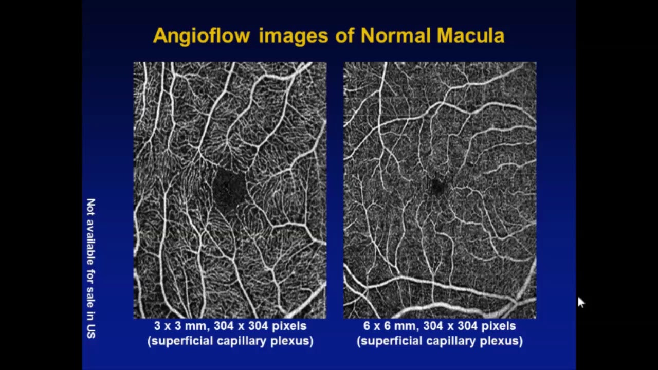 OCT and Fundus Imaging: An Update with Dr. Jerome Sherman - YouTube