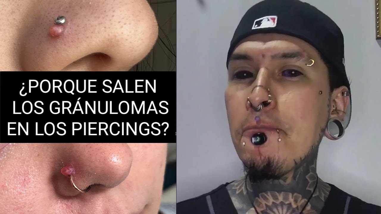 Porque salen gránulomas en los piercings? granuloma y queloide es lo ...