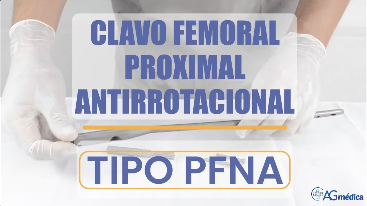 Clavo Femoral Proximal Antirrotacional (Tipo PFNA) - YouTube