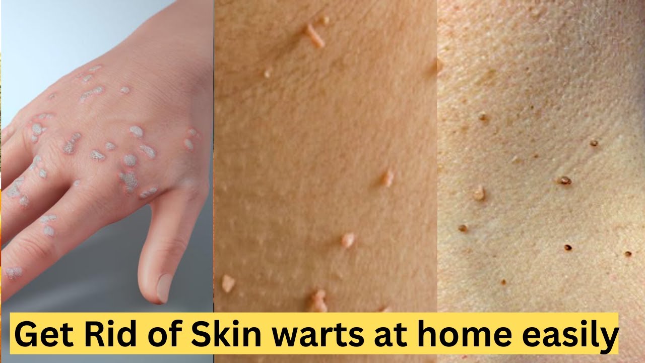 how to remove wart and body tags at home | home remedy for wart - YouTube