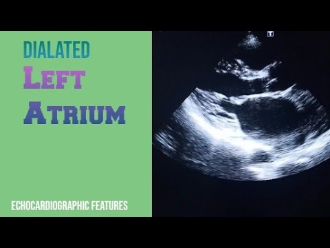 Echocardiographic features of Left Atrial enlargement| Left atrial ...