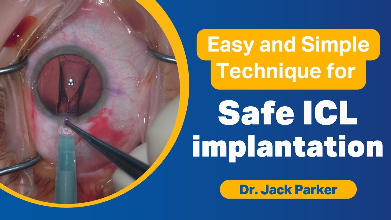 Easy and Simple Technique for Safe ICL implantation - YouTube
