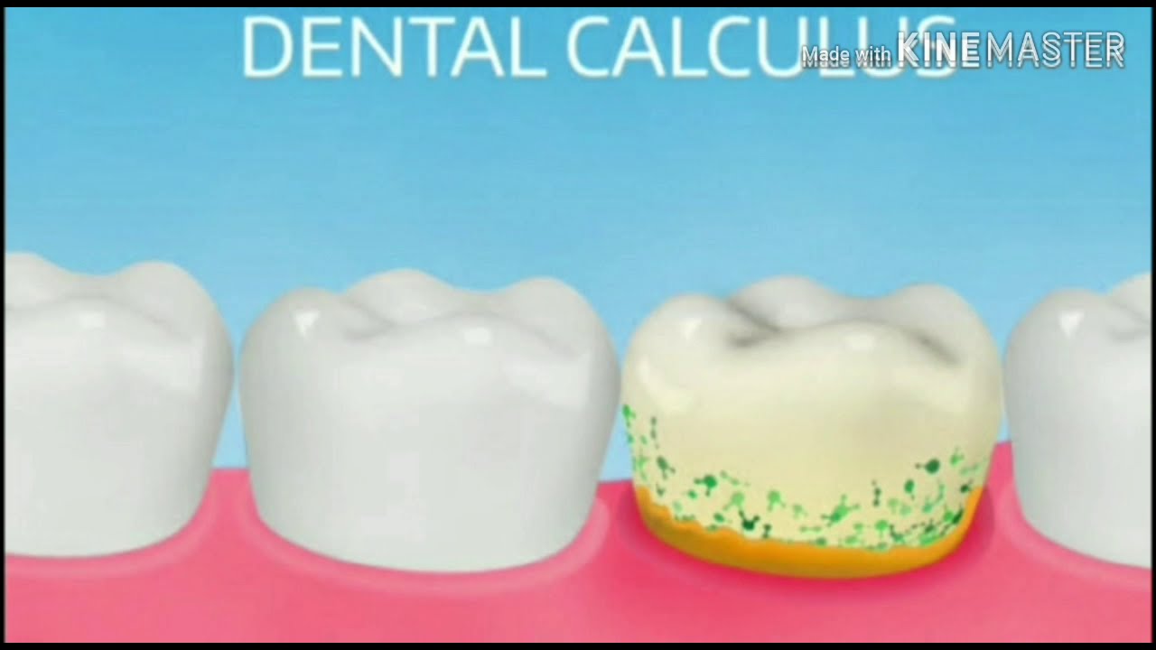 what is the difference plaque | calculus | how it is removed? | Tartar ...