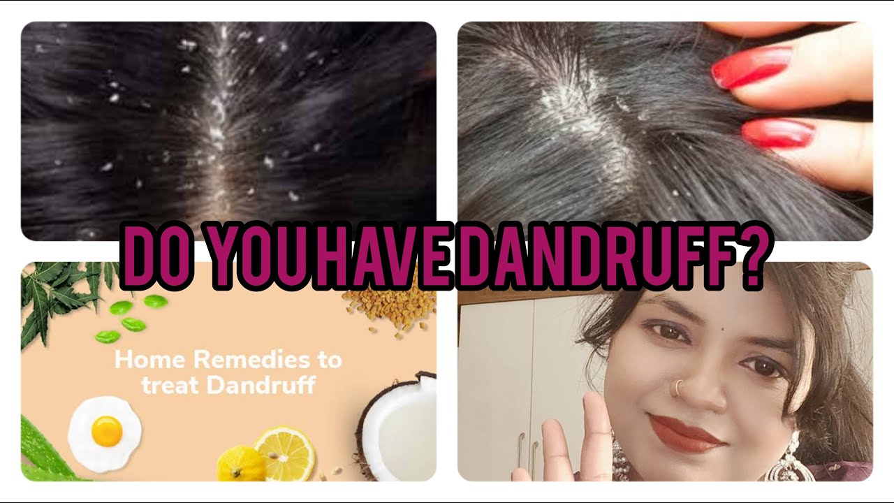 DIY to treat Dandruff permanently#homeremedies #homerediesforhairfall ️ ...