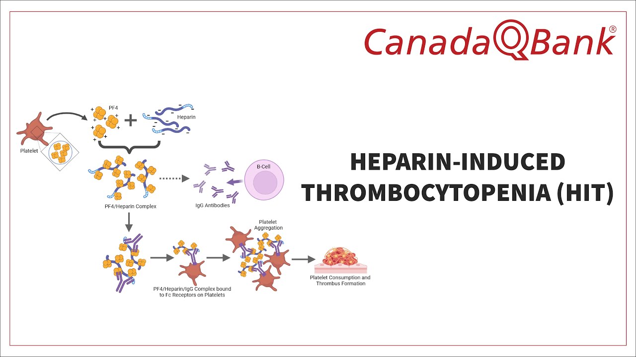 Heparin-Induced Thrombocytopenia (HIT) – Causes, Diagnosis, Treatment ...