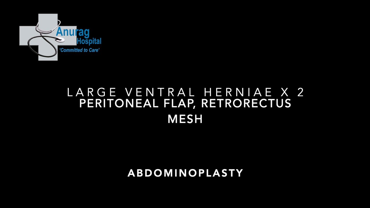 Large Ventral Hernia Peritoneal Flap Mesh with Hernioplasty Surgery ...