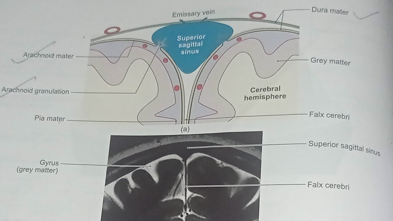 3.Arachnoid granulation: Neuroanatomy Diagrams BDC (Diagram 11) - YouTube