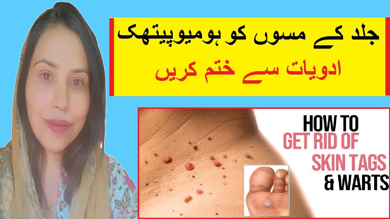 HOW TO GET RID OF SKIN WARTS NATURALLY | SKIN WARTS REMOVAL TIPS ...
