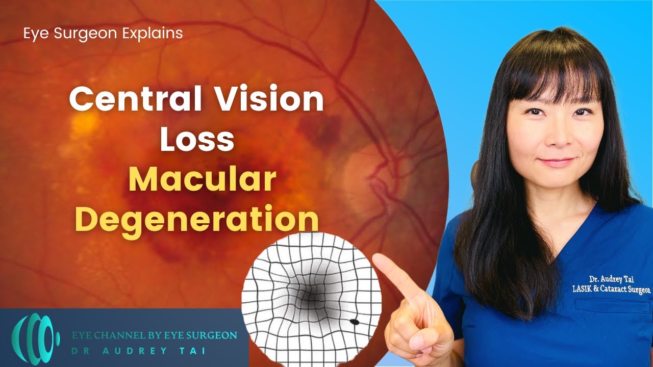 Macular Degeneration Everything You Need To Know Eye Surgeon Explains macular-degeneration-everything-you-need-to-know-eye-surgeon-explains
