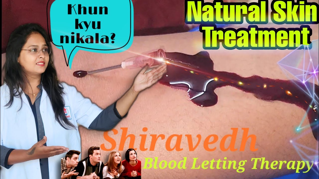 Khun kyu nikala? | Natural Skin Solution | Shira Vedha | Rakt mokshan # ...