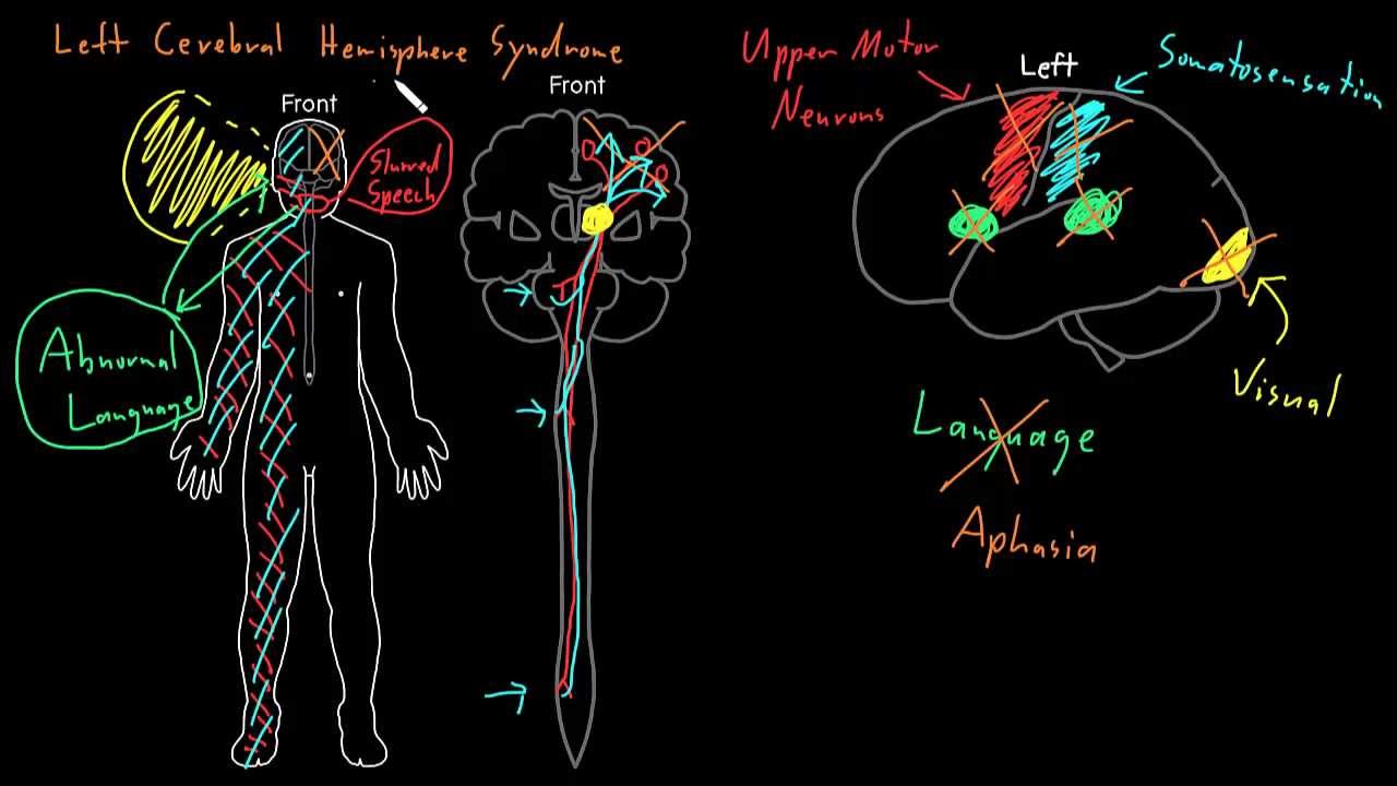 Syndrome: Left cerebral hemisphere syndromes - YouTube
