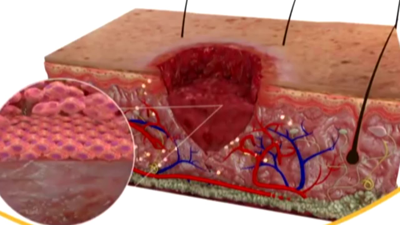 Skin Ulcer Causes Types Symptoms And Treatments