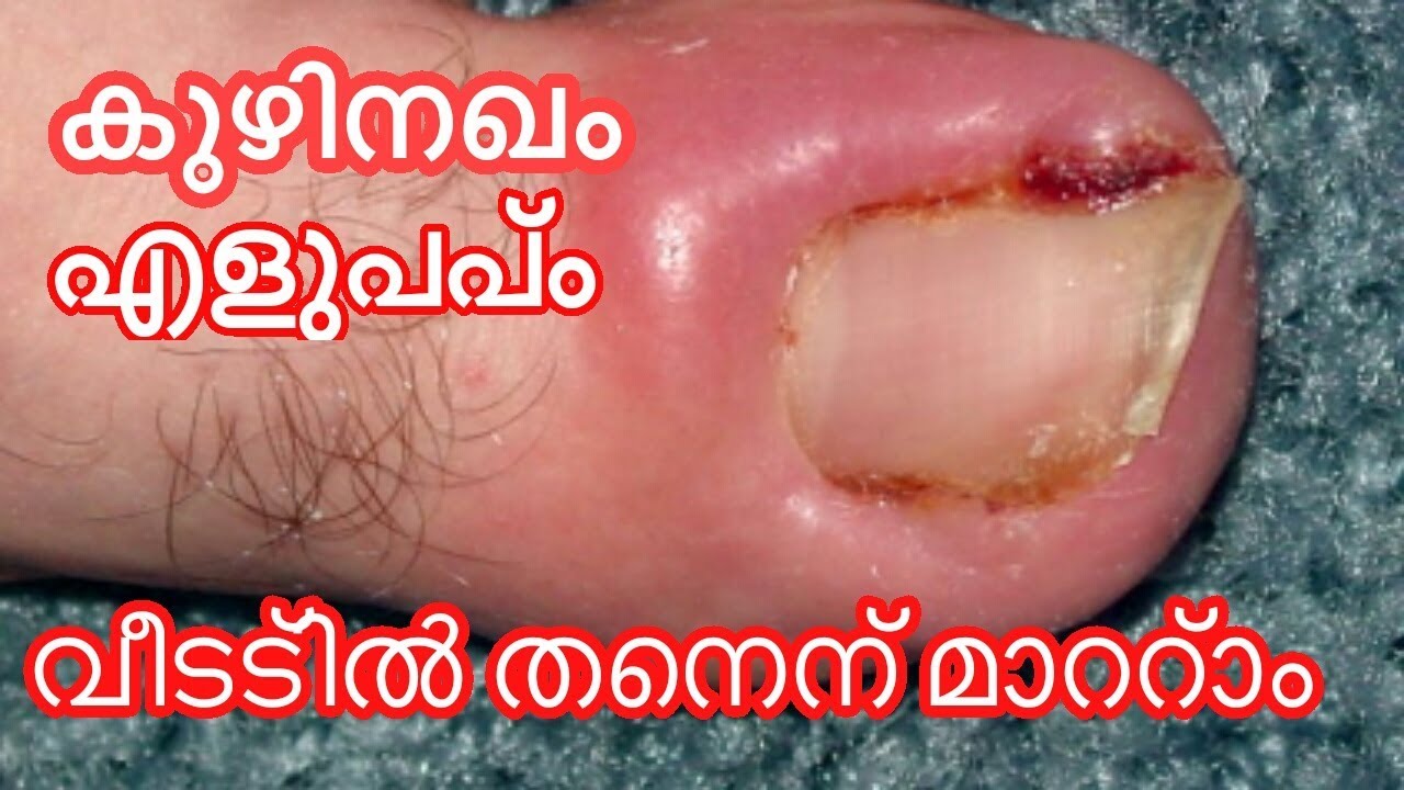കുഴിനഖം വളരെ പെട്ടെന്ന് വീട്ടിൽ വെച്ച് തന്നെ മാറ്റാം. Hangnail/agnail ...