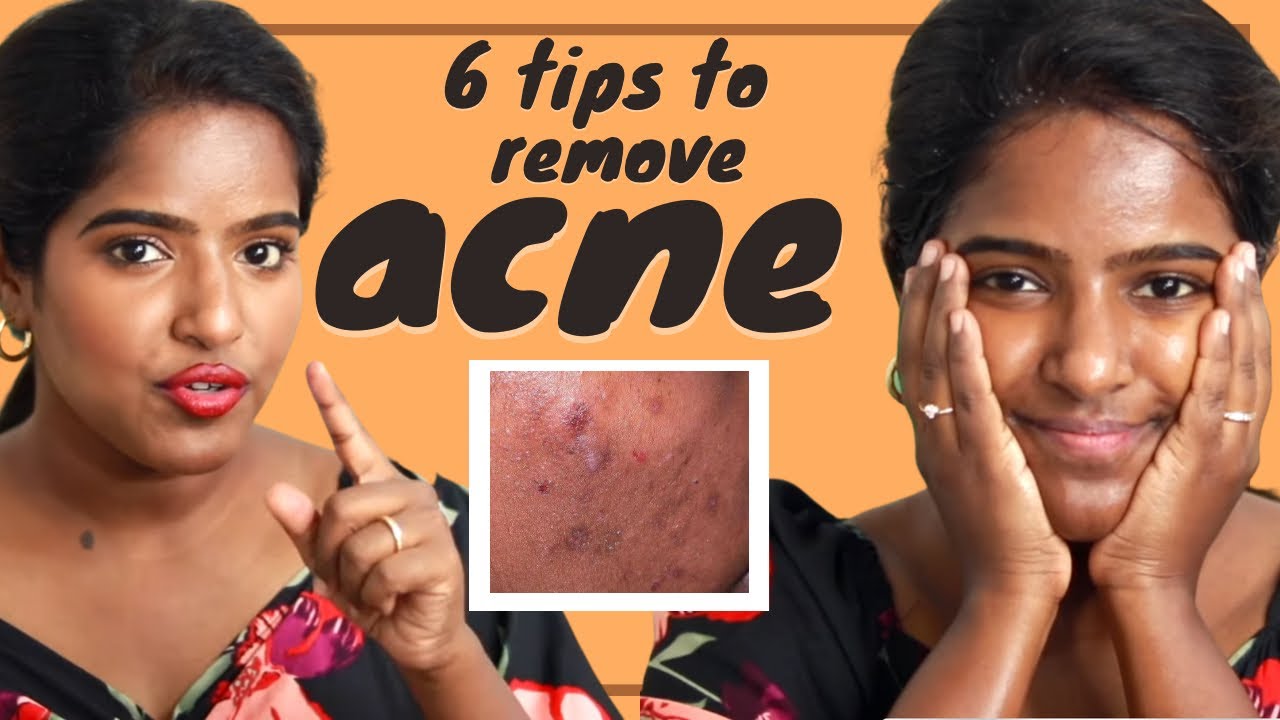 My Top 6 Tips To Control Acne!! Tips that Works Amazing to get clear ...