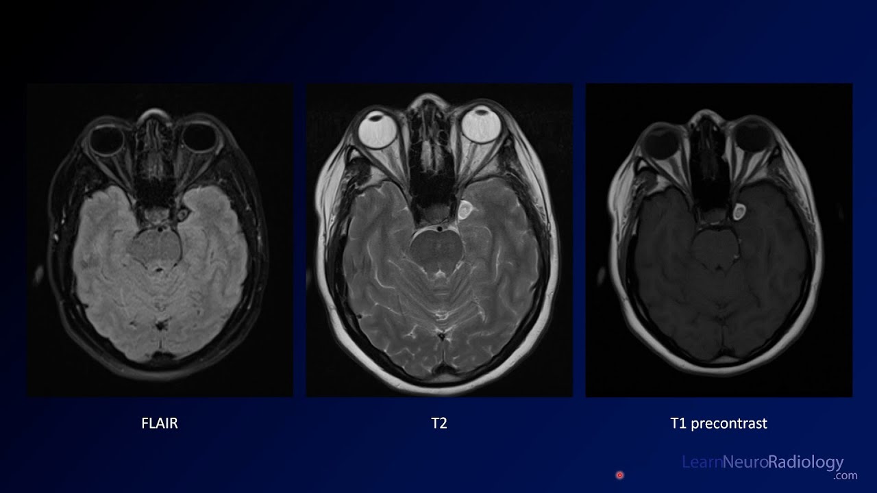 Dermoid Tumor Brain Mri