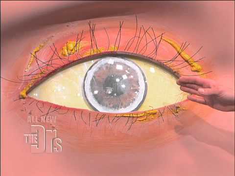 Cholesterol Deposits in the Eye (The Doctors)