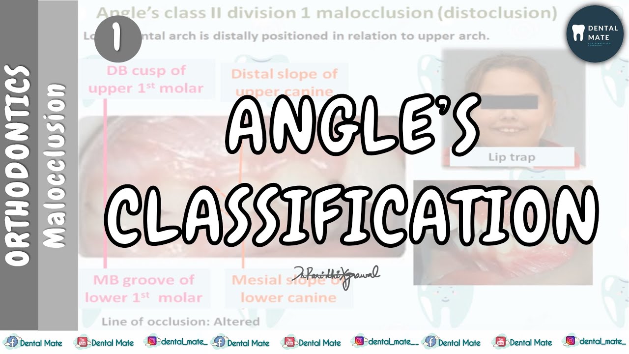 Angle's Classification of Malocclusion | Dr Paridhi Agrawal - YouTube