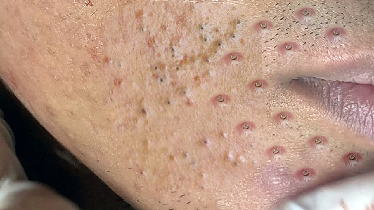 Suri Job #562: Awesome Big Acne Hidden Under Skin - YouTube