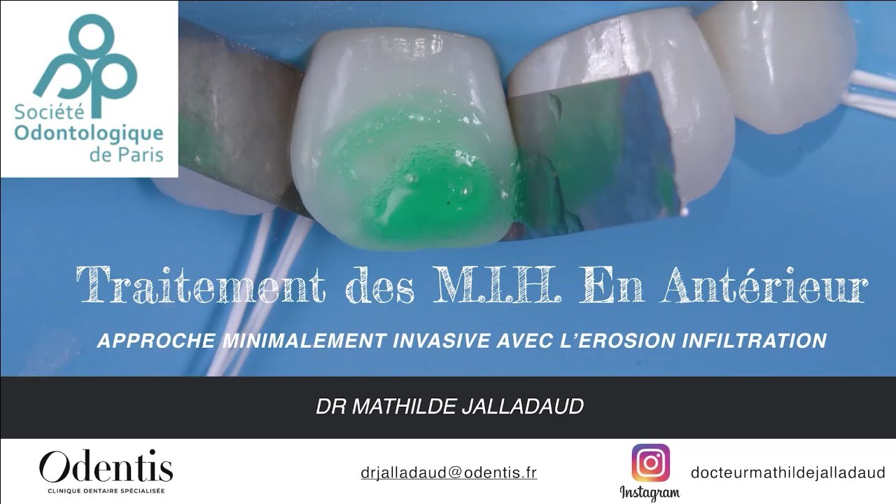 « Traitement des MIH en antérieur » par Mathilde Jalladaud - YouTube