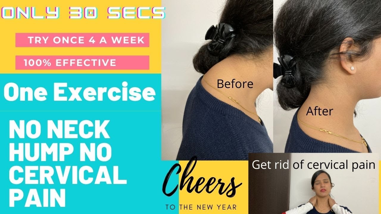 One exercise to cure cervical & neck hump - 100% effective - YouTube
