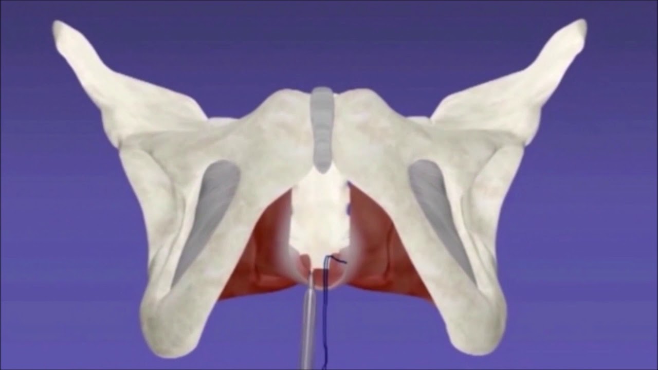 Autologous apical sling for Level I and anterior defect repair - YouTube