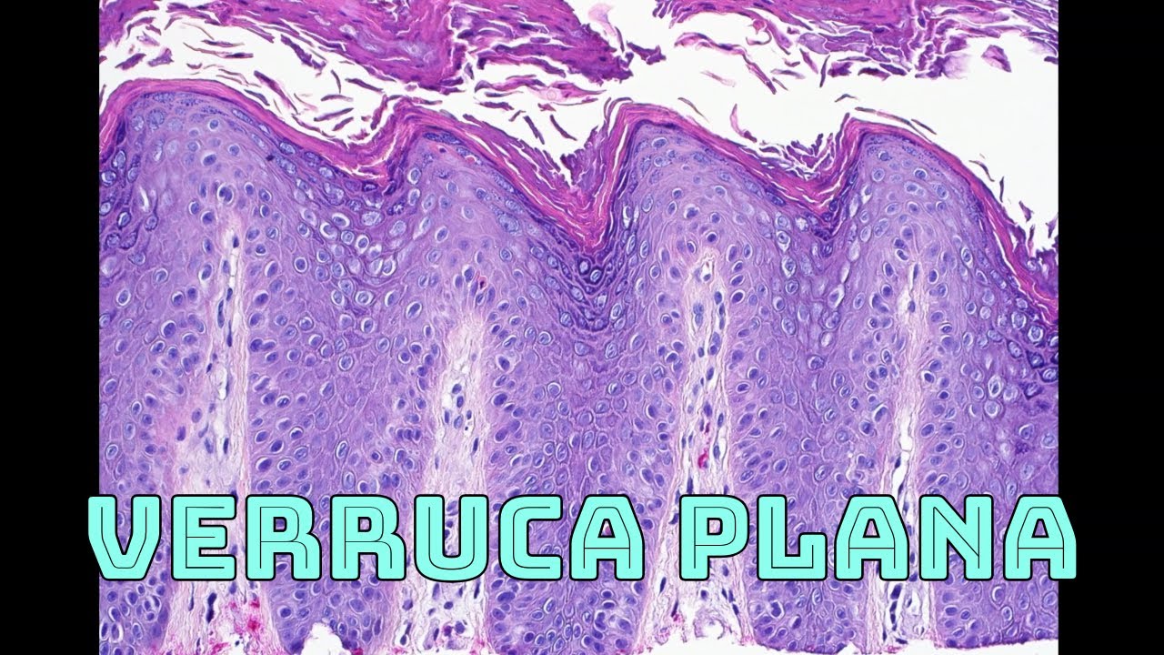Verruca Plana Histopathology Verrucous Plaques On Sun Exposed Areas