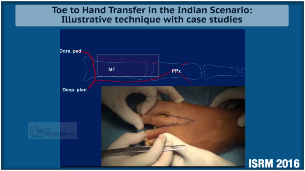 Toe to Hand Transfer in the Indian Scenario: Illustrative technique ...