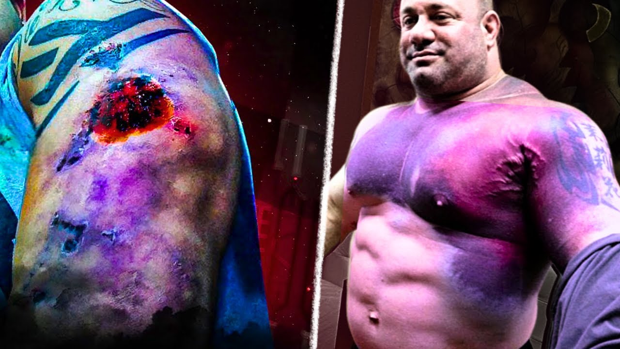 5 WORST Injuries in Bodybuilding - YouTube