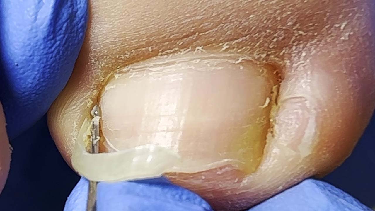 Pedicure Tutorial: The Complete Trimming Process for Ingrown Toenails ...