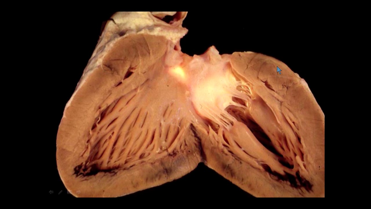 Normal Anatomy of the Heart - YouTube