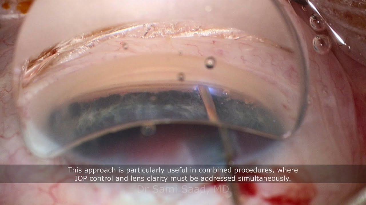 Combined Glaucoma MIGS with ELIOS Laser and Cataract Surgery | Dr Sami ...