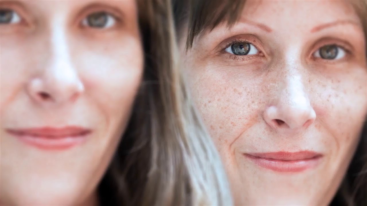 Photo Aging and Facial Wrinkles Treatment - YouTube