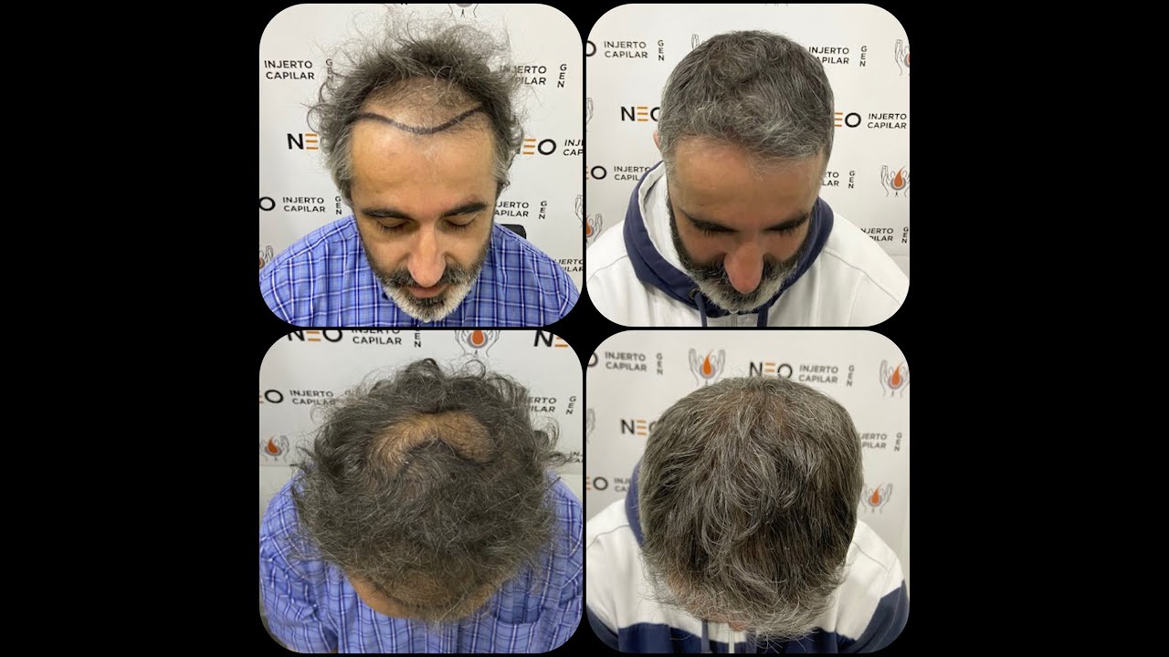 Tercio Frontal + Coronilla. Experiencia y garantías de éxito asegurados ...