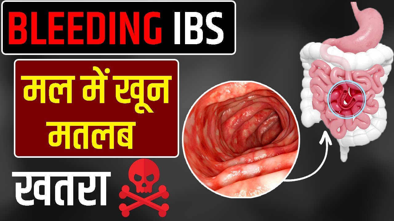 Bleeding IBS | Blood In Your Stool | Inflammatory Bowel Disease | IBS ...