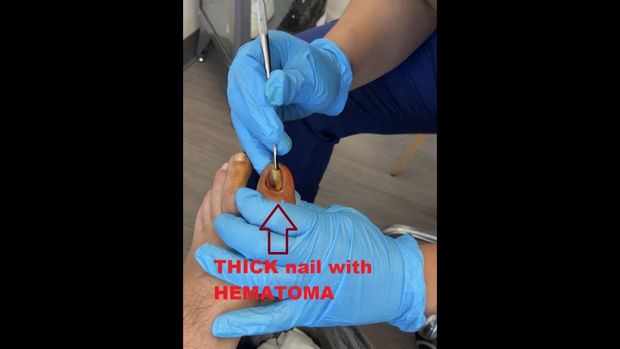 Full nail avulsion for hematoma relief #Thicknail #Ingrown # ...
