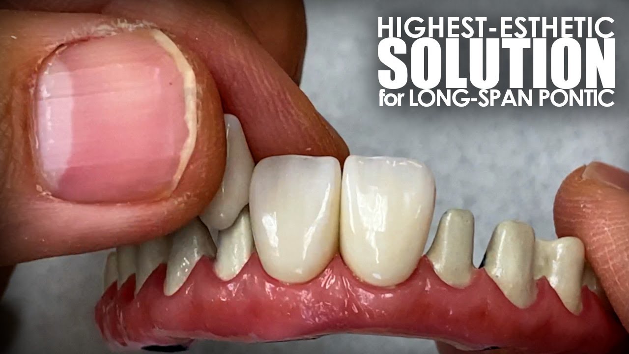 Making the Highest-Esthetic Solution for Long-Span Pontic - YouTube