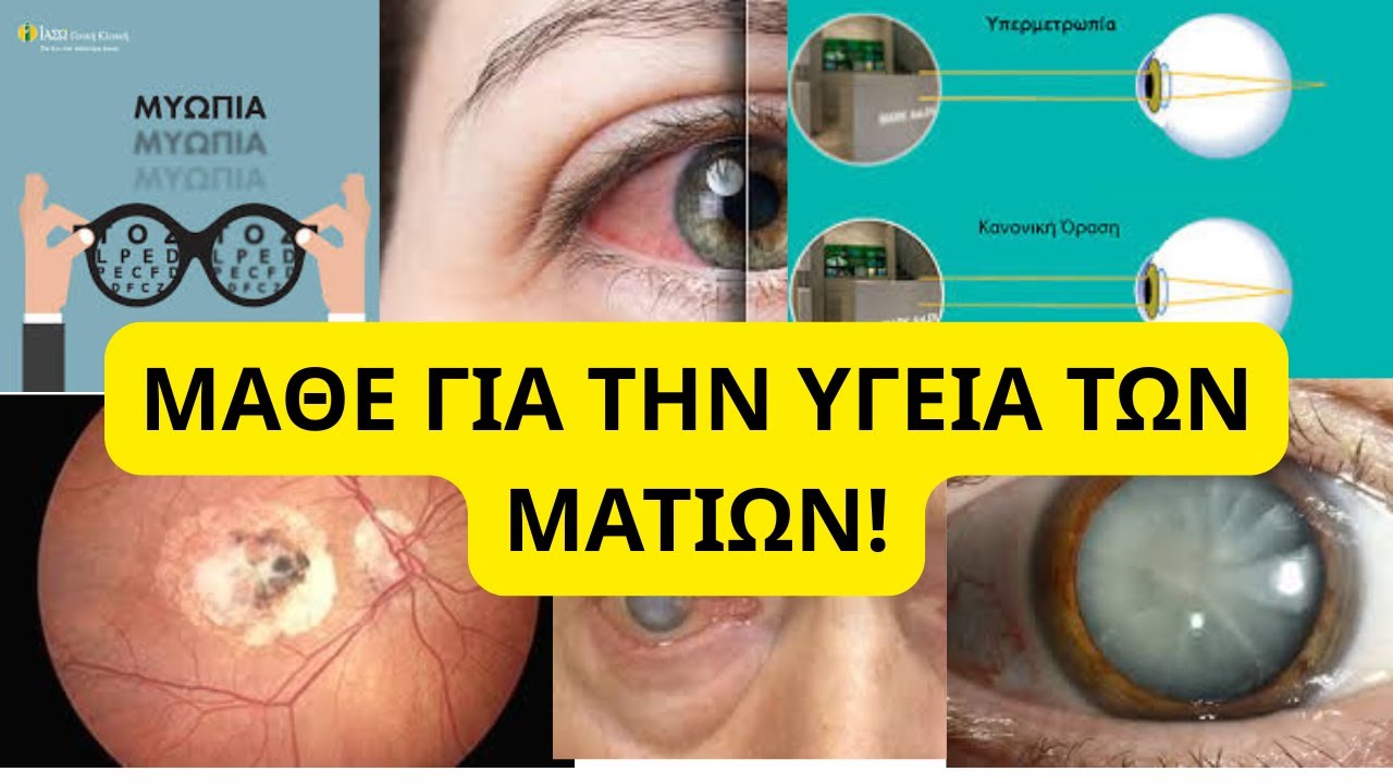 ΥΓΕΙΑ ΤΩΝ ΜΑΤΙΩΝ-ΣΥΝΗΘΕΣΤΕΡΕΣ ΠΑΘΗΣΕΙΣ ΚΑΙ ΘΕΡΑΠΕΙΕΣ - YouTube