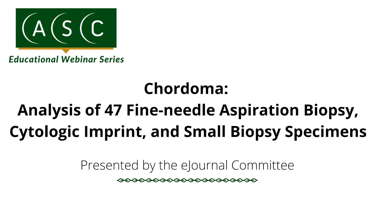 Chordoma: Analysis of 47 Fine-needle Aspiration Biopsy, Cytologic ...