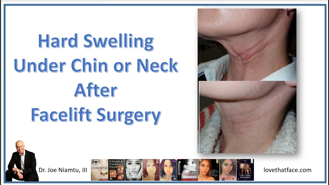 Hard Swelling Under the Chin and Neck after Facelift Surgery - YouTube