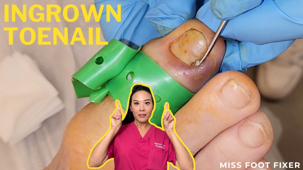 Quick Relief For Ingrown Toenails: Pain-Free Removal And Care Tips ...