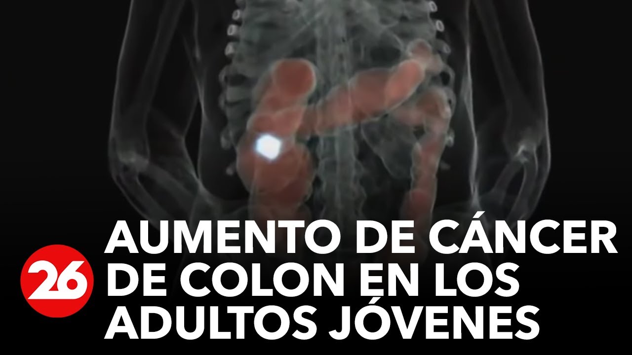 Aumentan diagnósticos de cáncer de colón en menores de 55 años: ¿Cómo ...