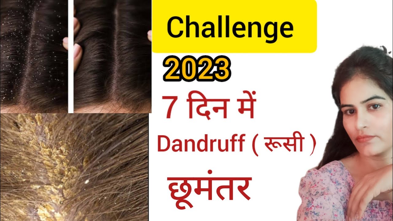 बिना मेहनत के 10 दिन में Dandruff से छुटकारा:In 10 Days Remove 100 ...
