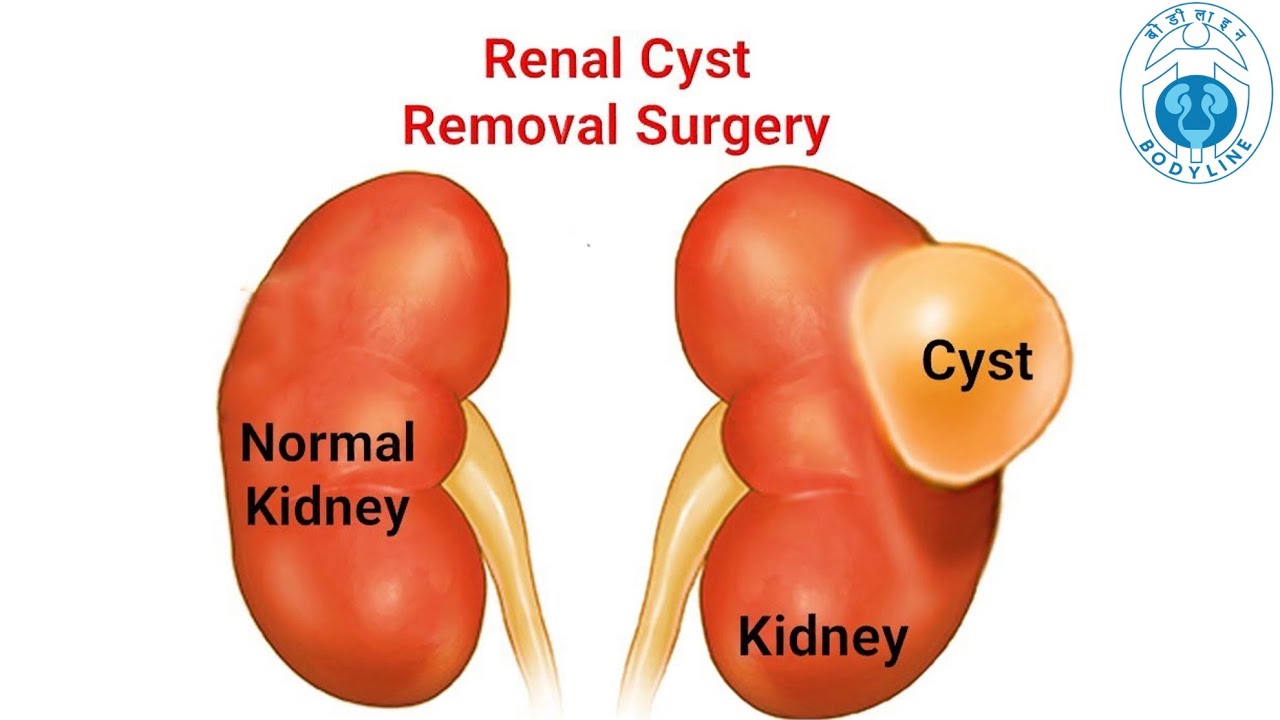 Laparoscopic Renal Cyst Deroofing @Bodylinehospitals by ...