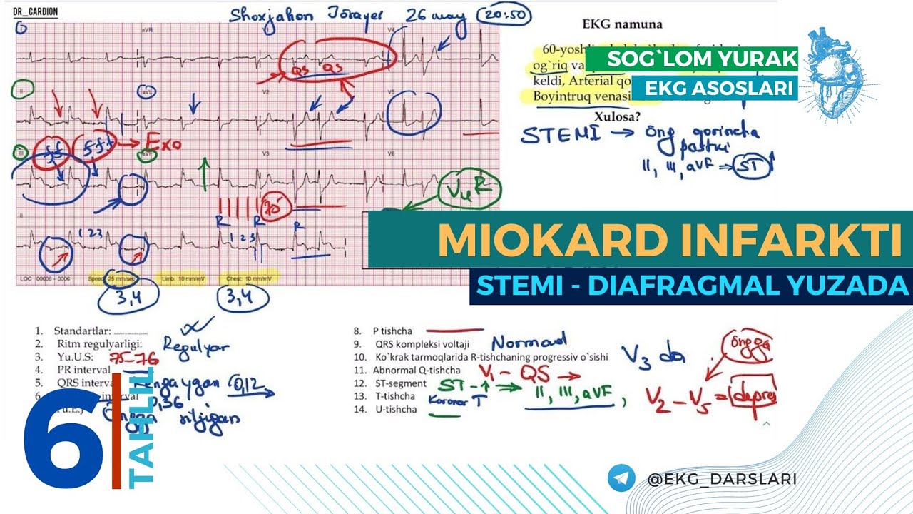 = EKG Tahlili-06 = Miokard Infarkti = EKG Namunasi = - YouTube
