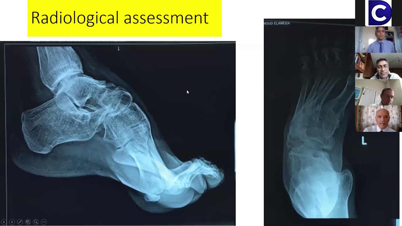 WEBINAR 3 - PRINCIPLES OF FOOT AND ANKLE DEFORMITY CORRECTION - YouTube