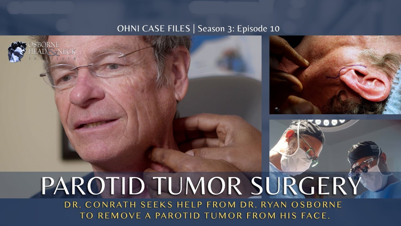 Retired oncologist shares his journey to remove his parotid tumor - YouTube