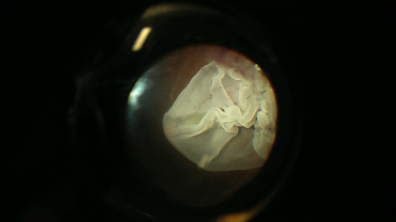 One of my worst Retinal Detachment (360 degree Giant Retinal Tear ...