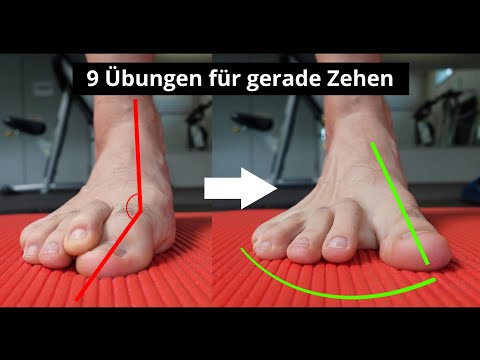 Hallux Valgus für Anfänger - 9 Übungen für gerade Zehen
