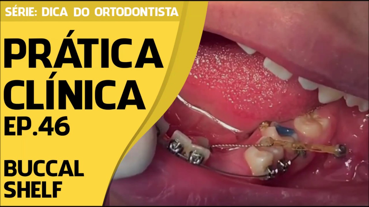PRÁTICA CLÍNICA ORTODÔNTICA SOBRE BUCCAL SHELF I EP. 46 I PROF. FABIO ...